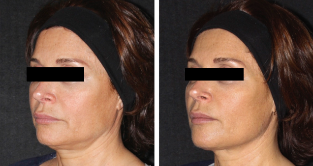 Lifting du visage sans chirurgie en Tunisie : pose des fils tenseurs